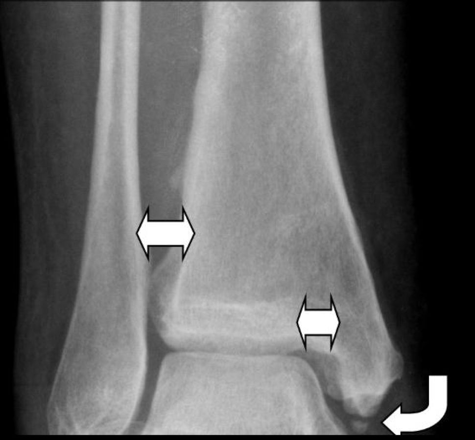 Die Ballackverletzung: Verletzung des Syndesmosebandes schwächt das ...