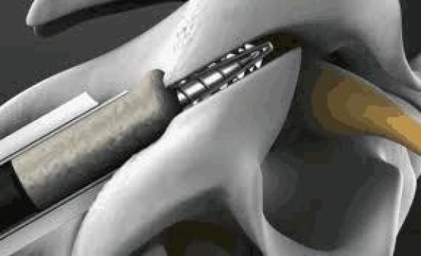 DTRAX - Perkutanes Verfahren zur Dekompression und Fusion der HWS - openPR